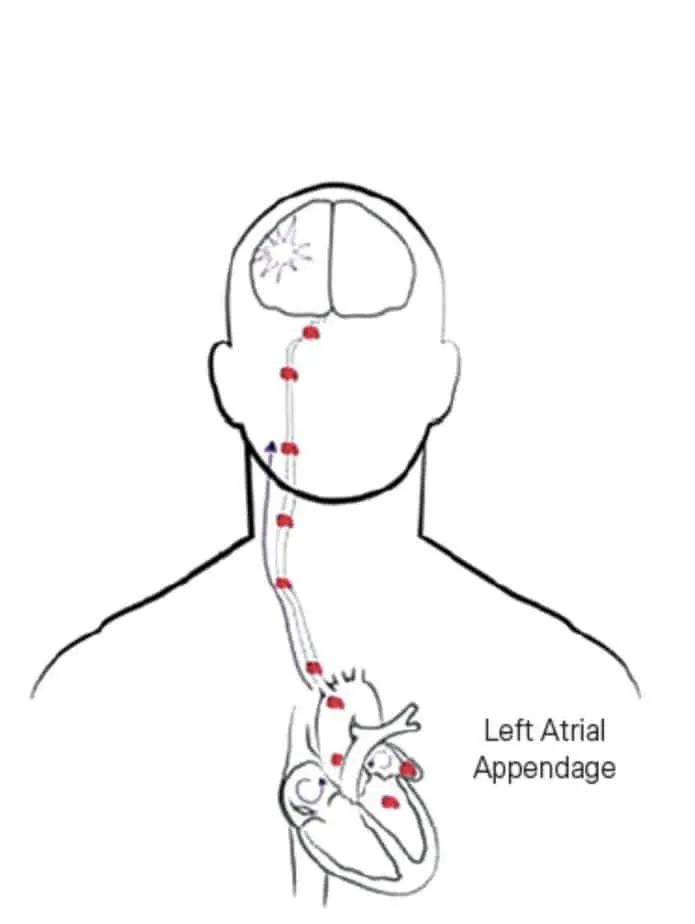 Left Atrial Appendage (LAA)